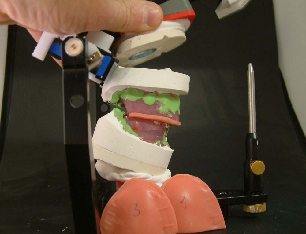 Piano occlusale – Laboratorio Maurizio Melano – Metodo Slaviceck