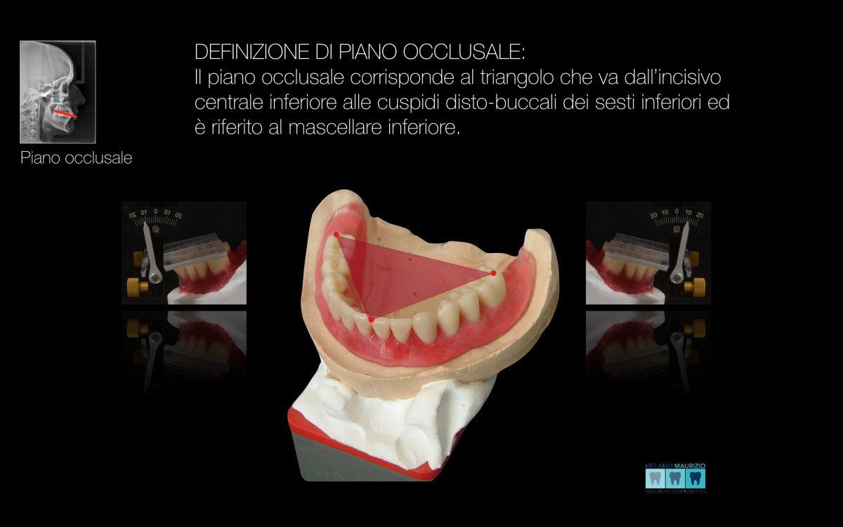 Piano occlusale – Laboratorio Maurizio Melano – Metodo Slaviceck